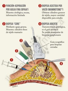 ¿Qué es una punción con aguja fina? - Dr. Humberto López Fernández